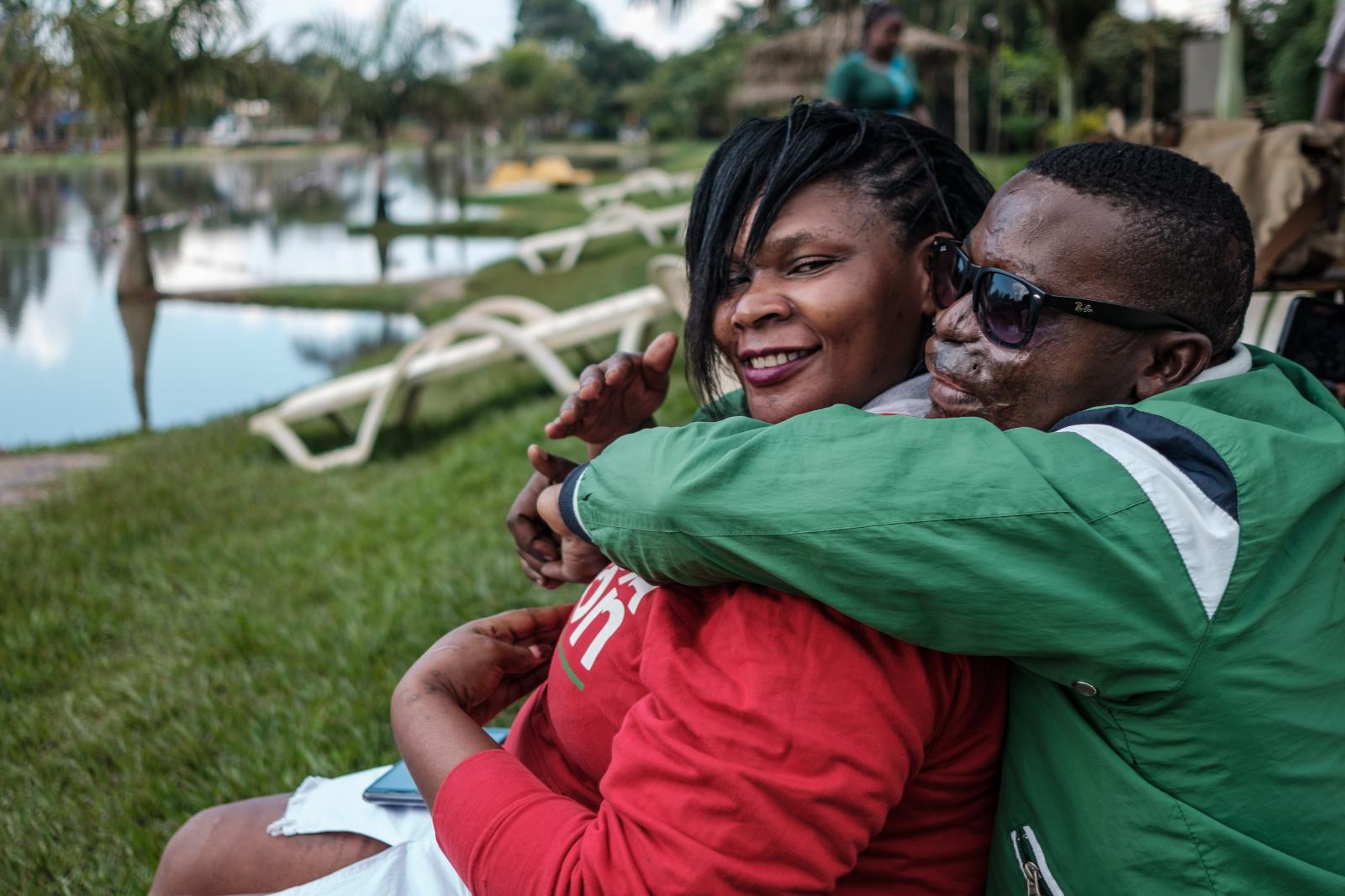 Uganda s Acid Attack Survivors Live On By Sumy Sadurni uganda-s-acid-attack-survivors-live-on-by-sumy-sadurni